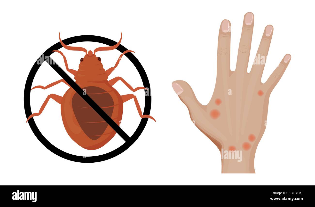 Bed bug infestation causing skin rashes, stop sign over pest and hand ...