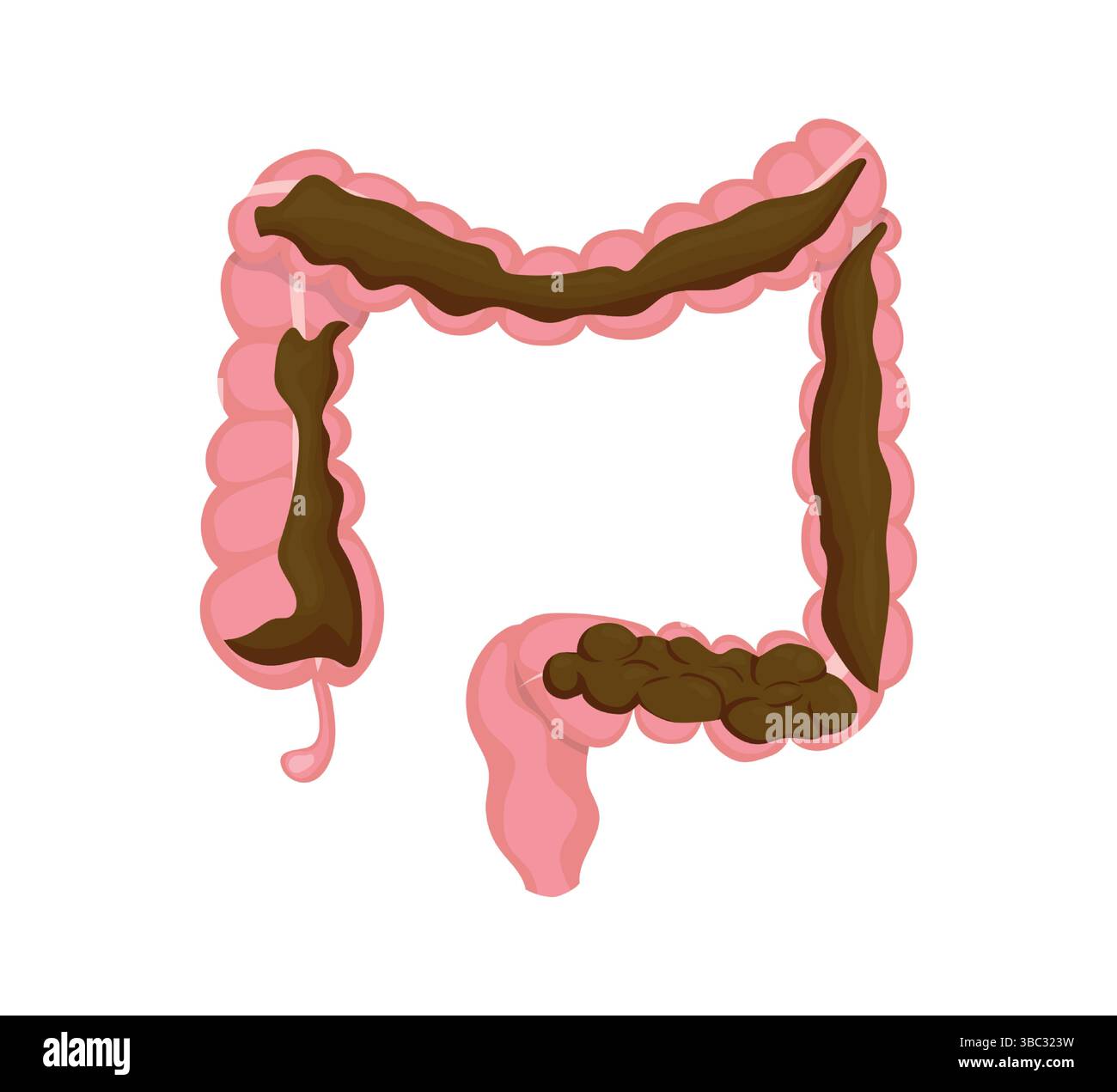 Medical illustration showing the process of feces moving through the ...