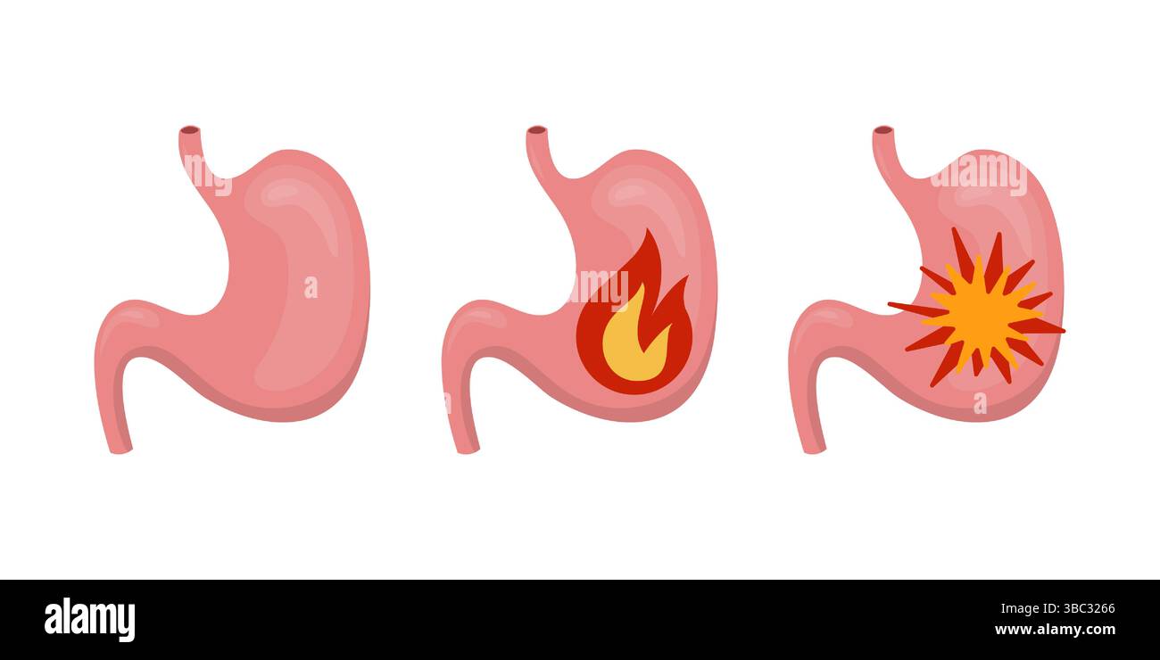 Three human stomachs showing healthy stomach, stomach with heartburn ...