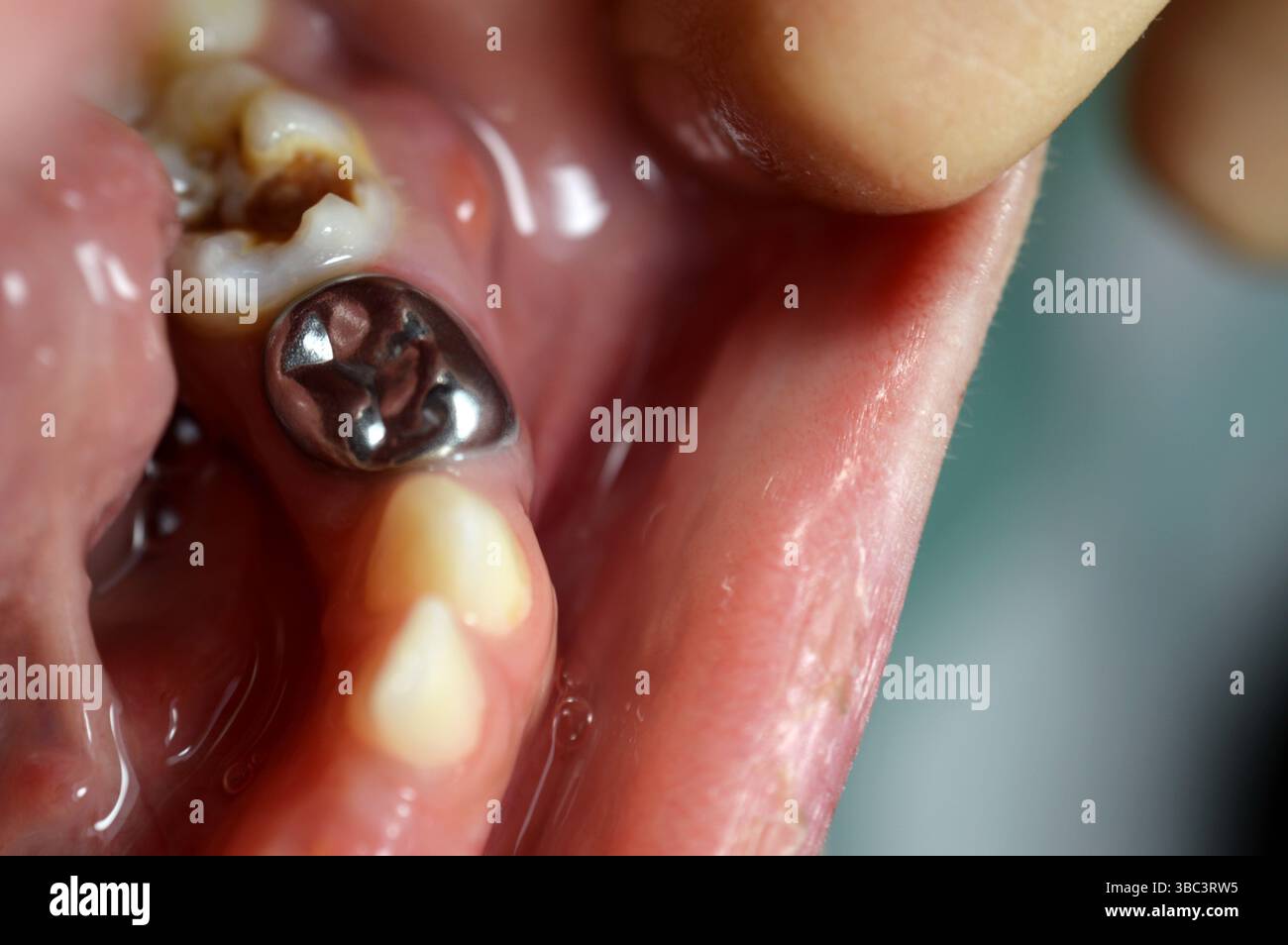 A 7 years old child, with a stainless steel crown for a tooth after ...