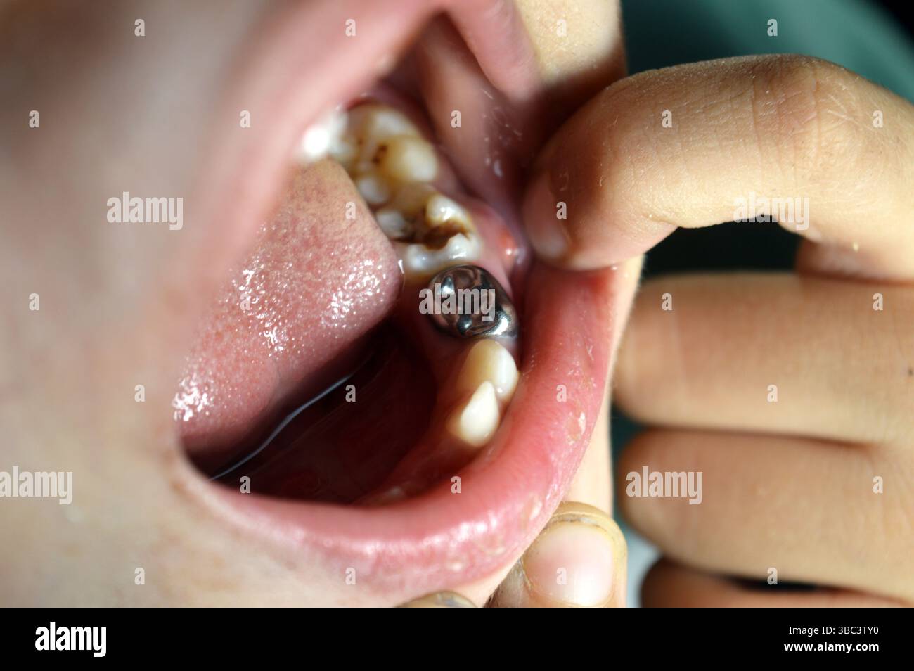 A 7 years old child, with a stainless steel crown for a tooth after ...