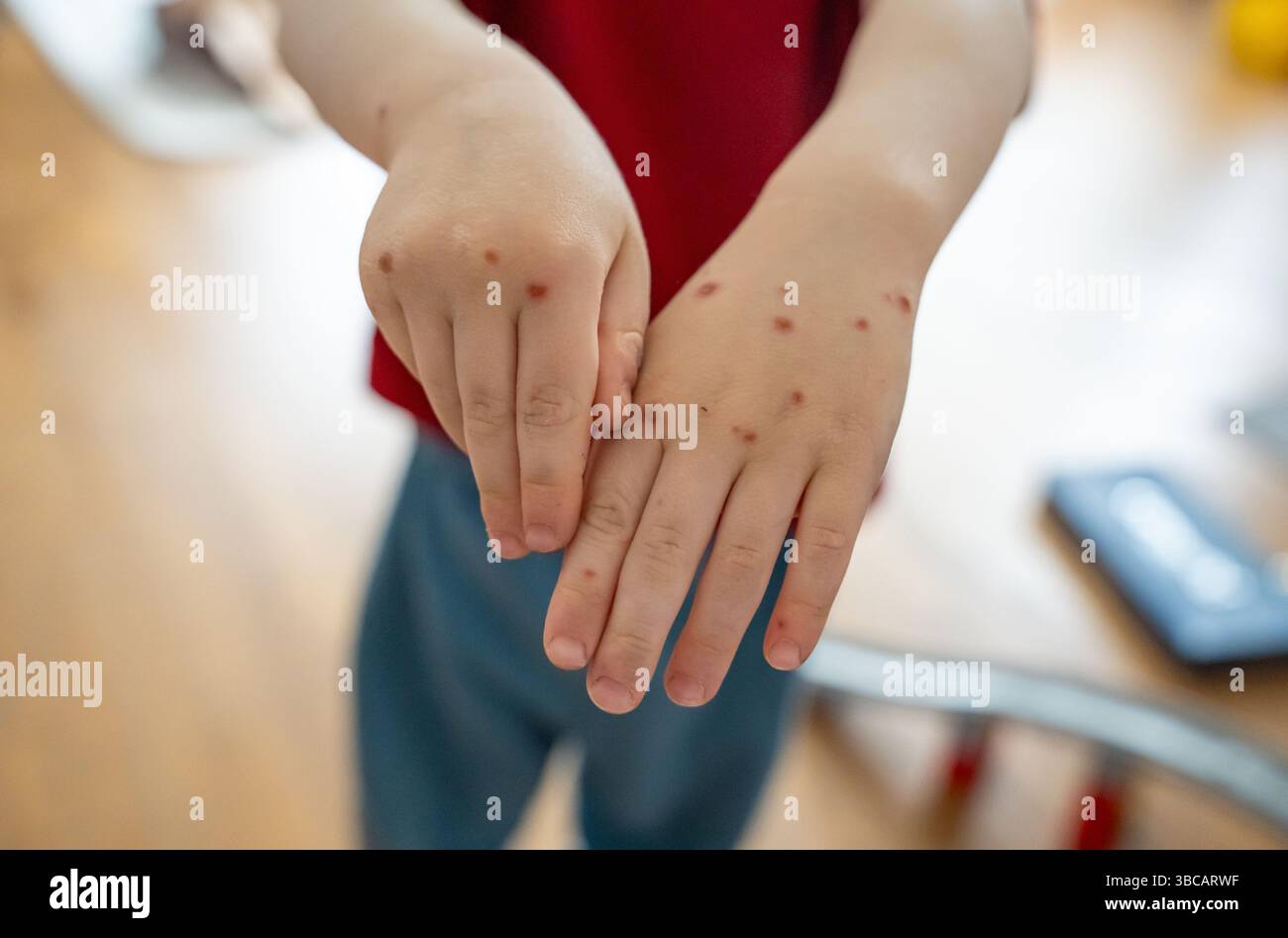 Pimples on a child's hands from the Coxsackie virus. Coxsackievirus. A ...