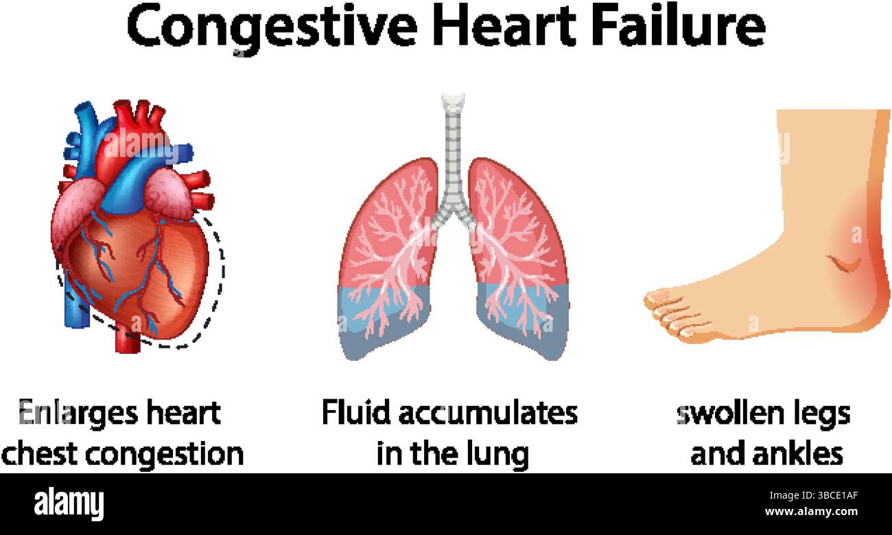 Vector illustration showing heart, lungs, and swollen foot. Highlights ...