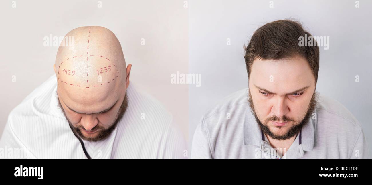 before and after bald head of a man . the process of hair ...