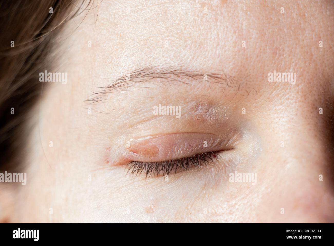 Removed papillomas on the eyelid of a young girl after cauterization ...