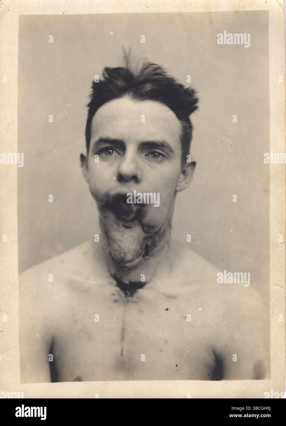 Soldier facial injuries 29 - Historical document, photographer unknow ...