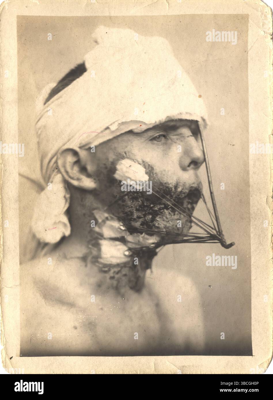 Soldier facial injuries 34 - Historical document, photographer unknow ...