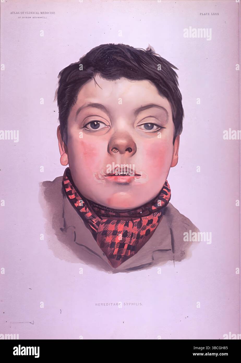 Hereditary or Congenital Syphilis Hereditary Syphilis - Historical ...