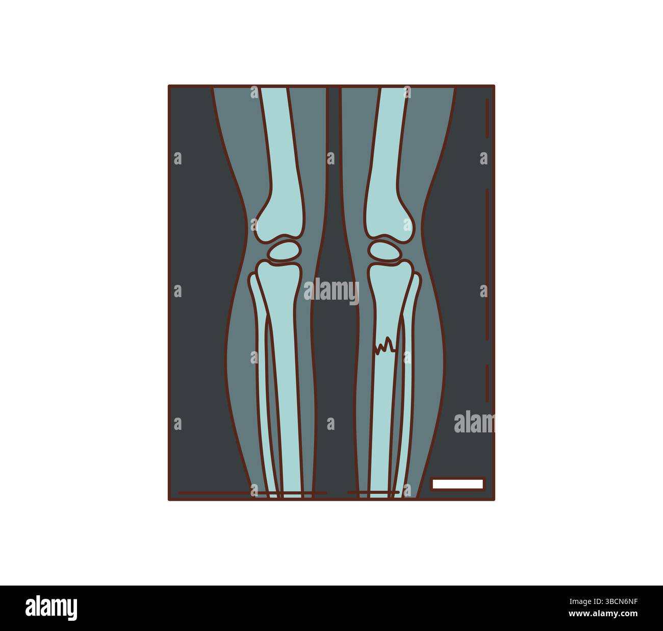 Cartoon groovy xray scan showing human leg bones, with a visible ...