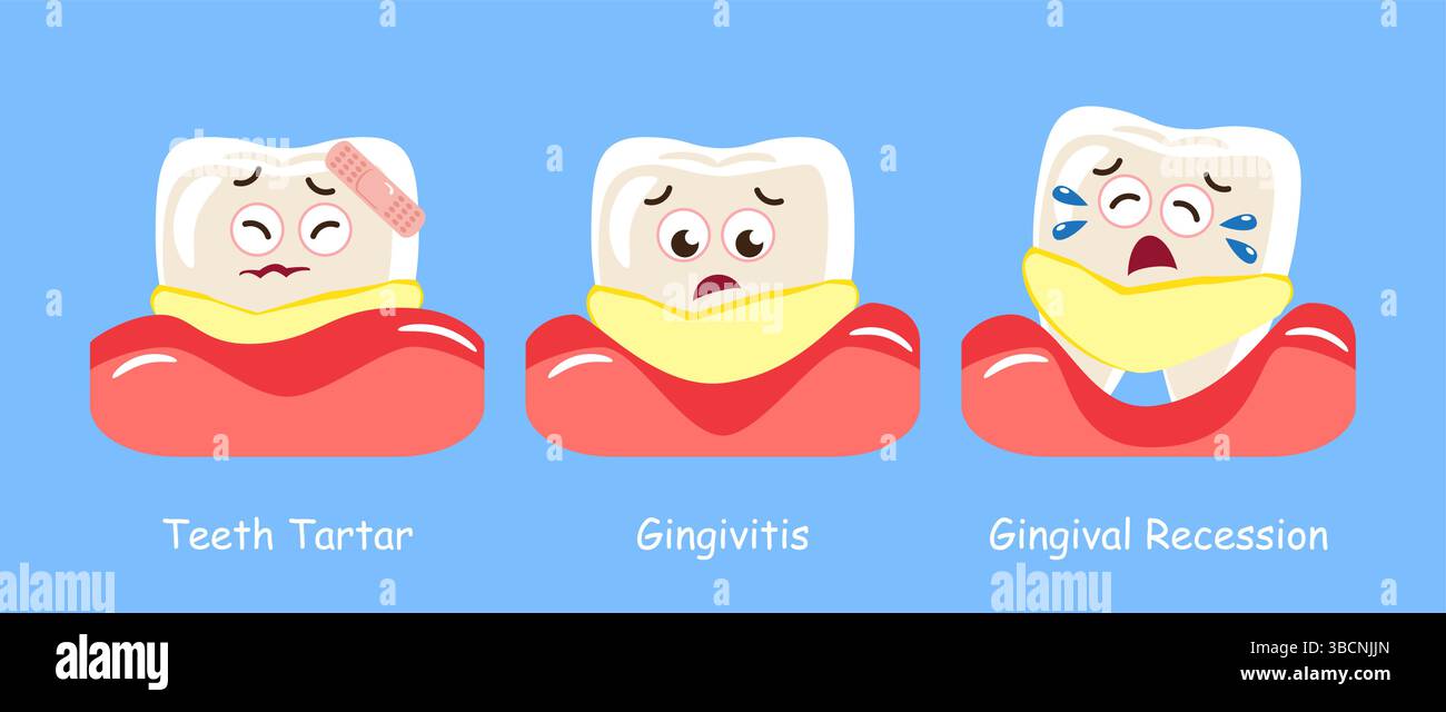 Progression of periodontitis . Teeth tartar, gingivitis and gingival ...