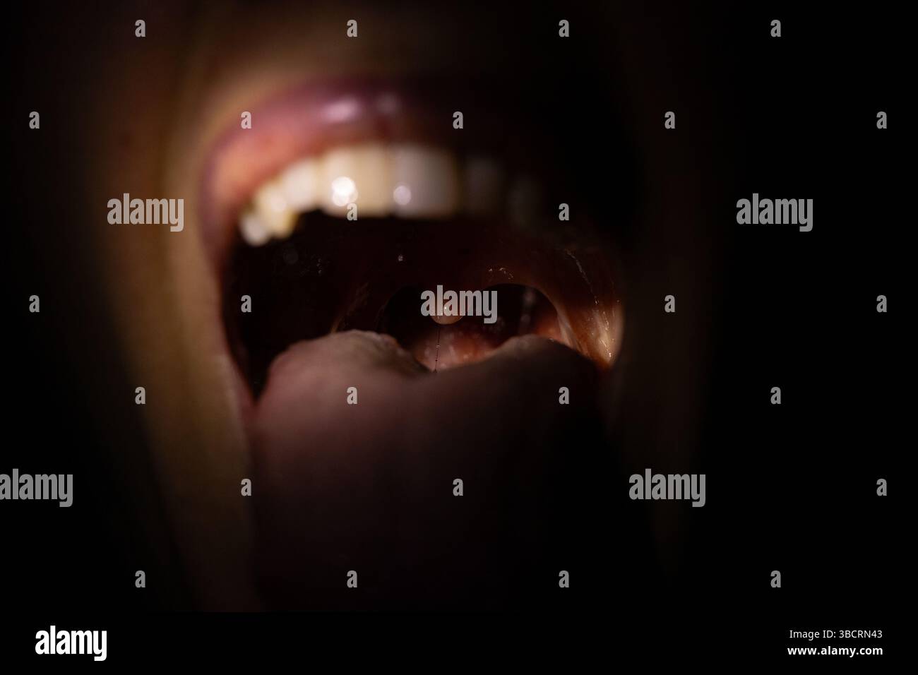 Open mouth view tonsils hi-res stock photography and images - Alamy