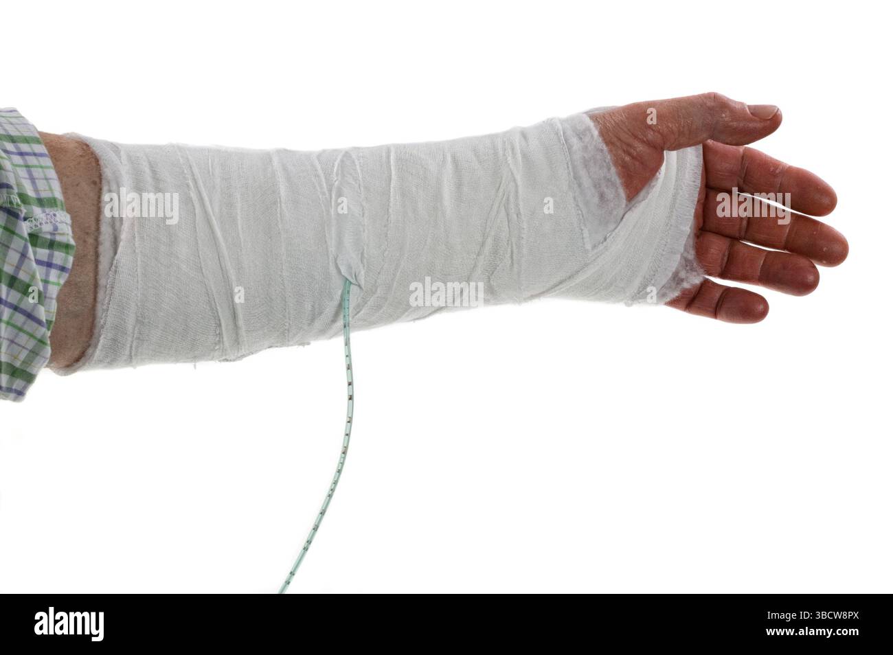Bandage with a drainage after surgery on carpal tunnel syndrome, CTS ...