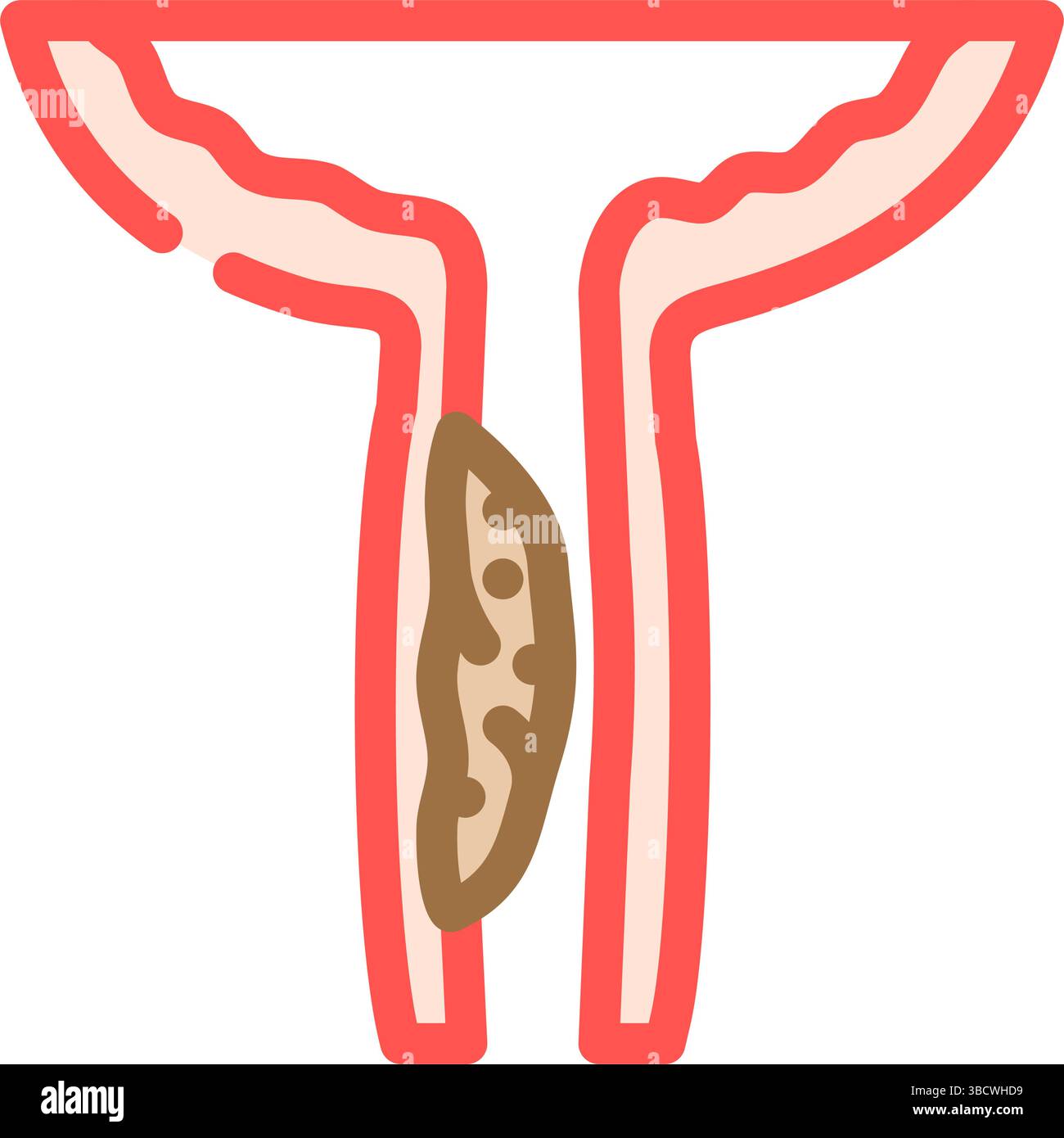 urethral stricture urology color icon vector illustration Stock Vector ...