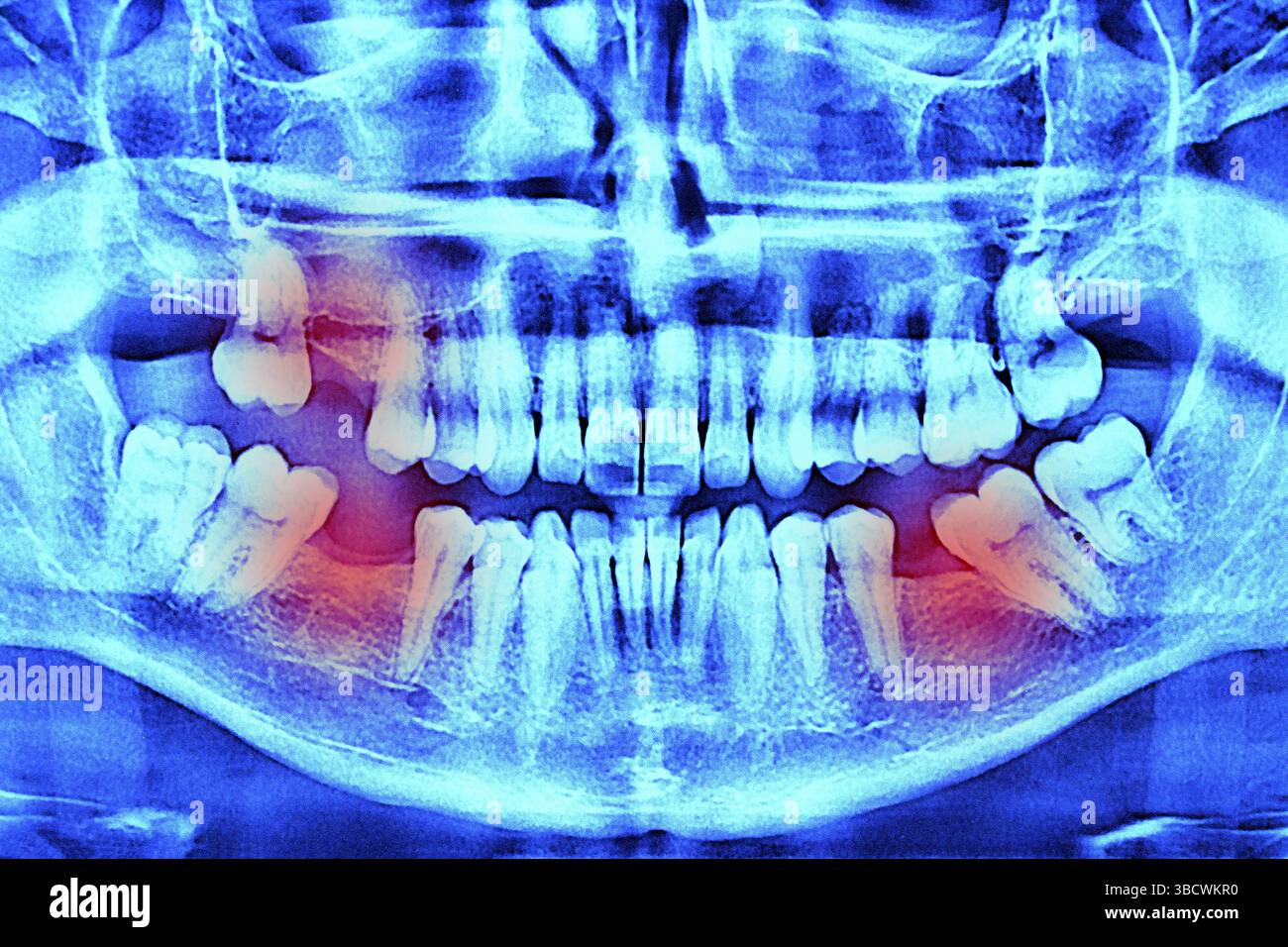 Panoramic x-ray of a male jaw without several teeth, dentistry and ...