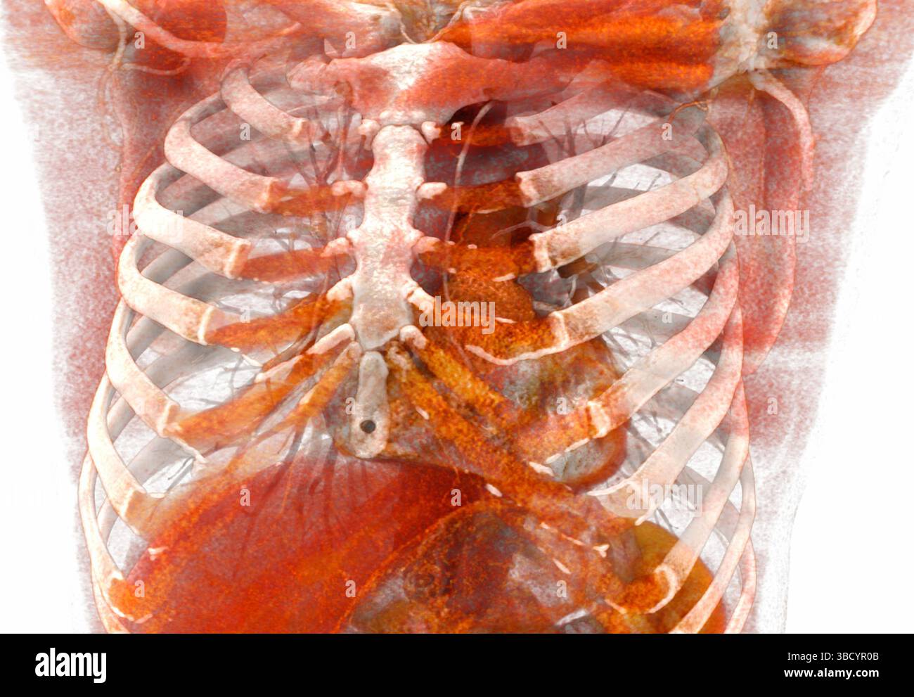 3D coloured computed tomography (CT) angiogram scan of an ascending ...