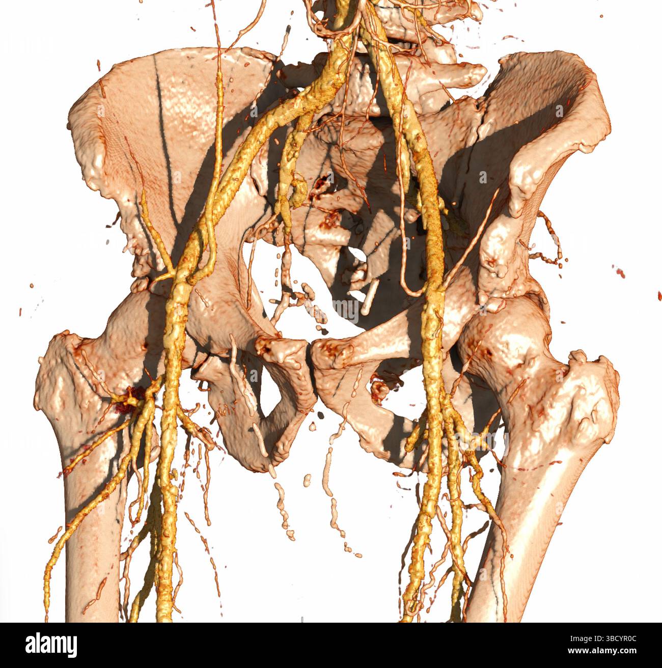 Atherosclerosis in pelvic area, CT angiogram Stock Photo - Alamy