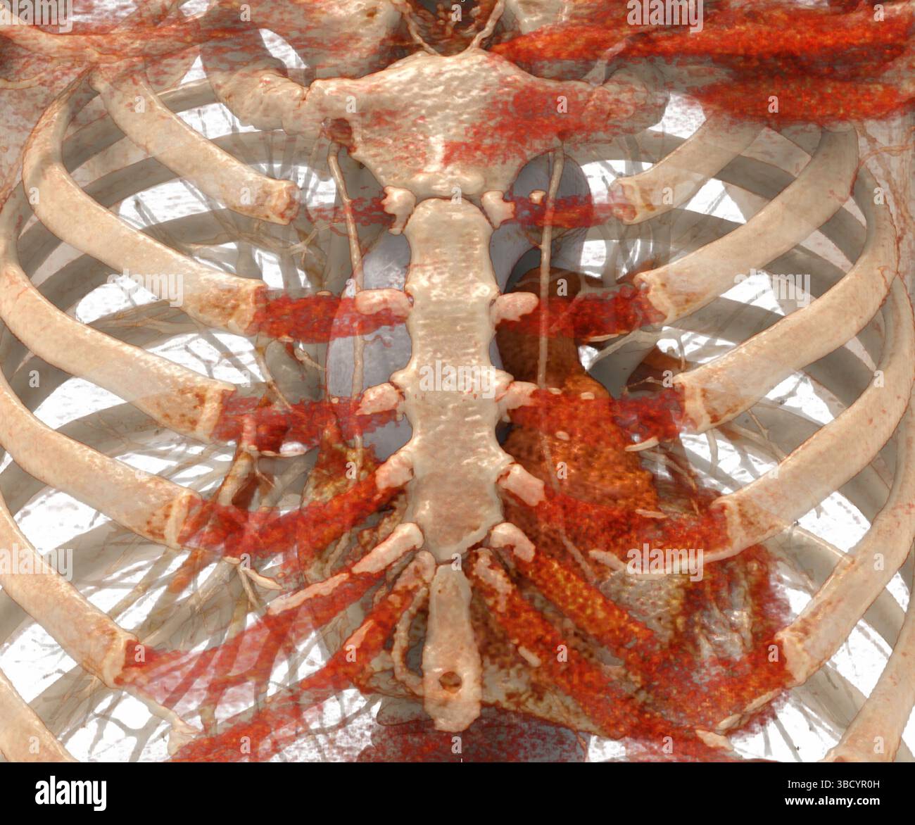 3D coloured computed tomography (CT) angiogram scan of an ascending aortic aneurysm with ...