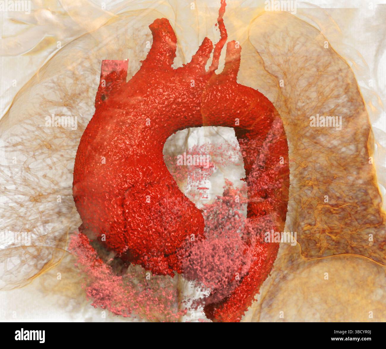 3D coloured computed tomography (CT) angiogram scan of an ascending ...