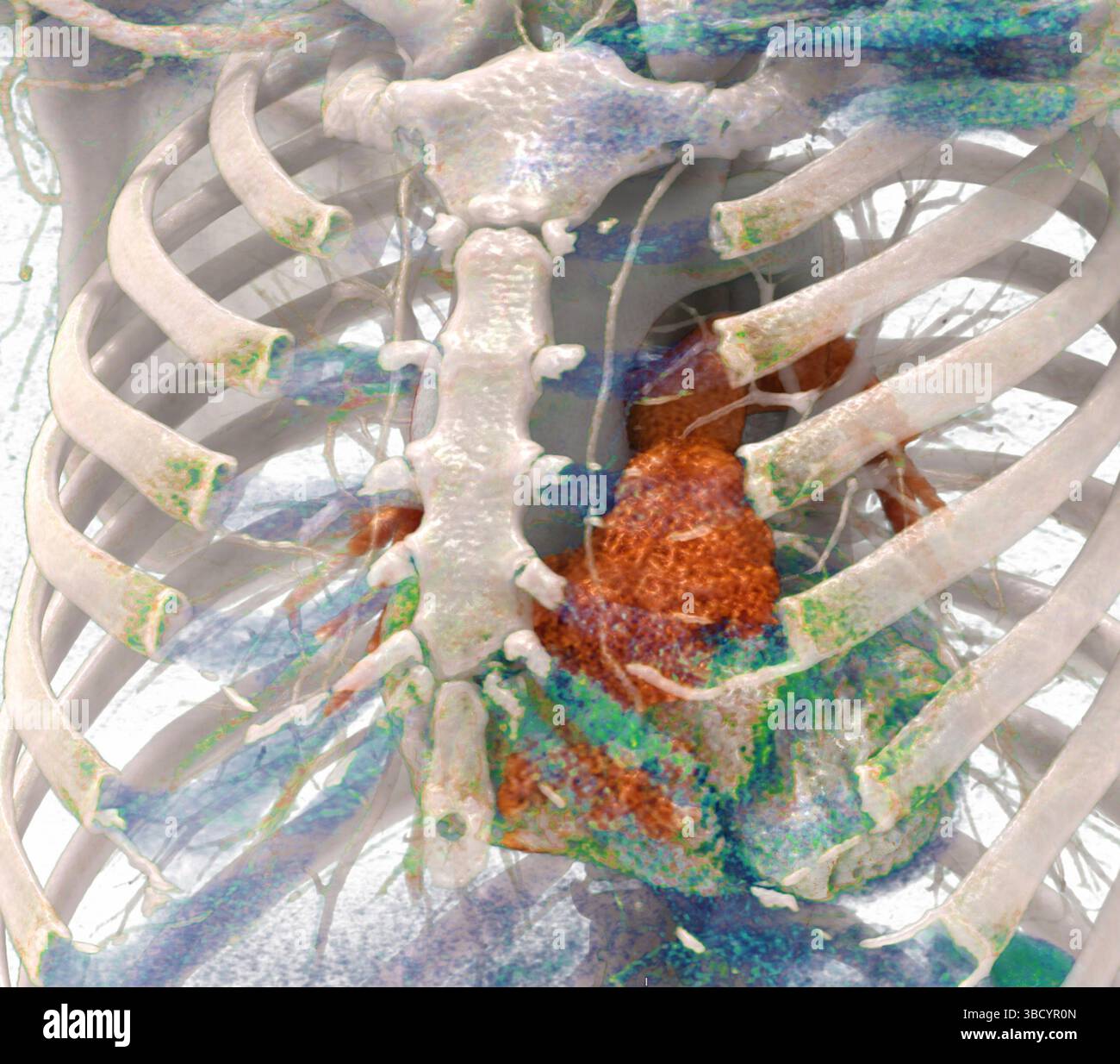 3D coloured computed tomography (CT) angiogram scan of an ascending aortic aneurysm with ...