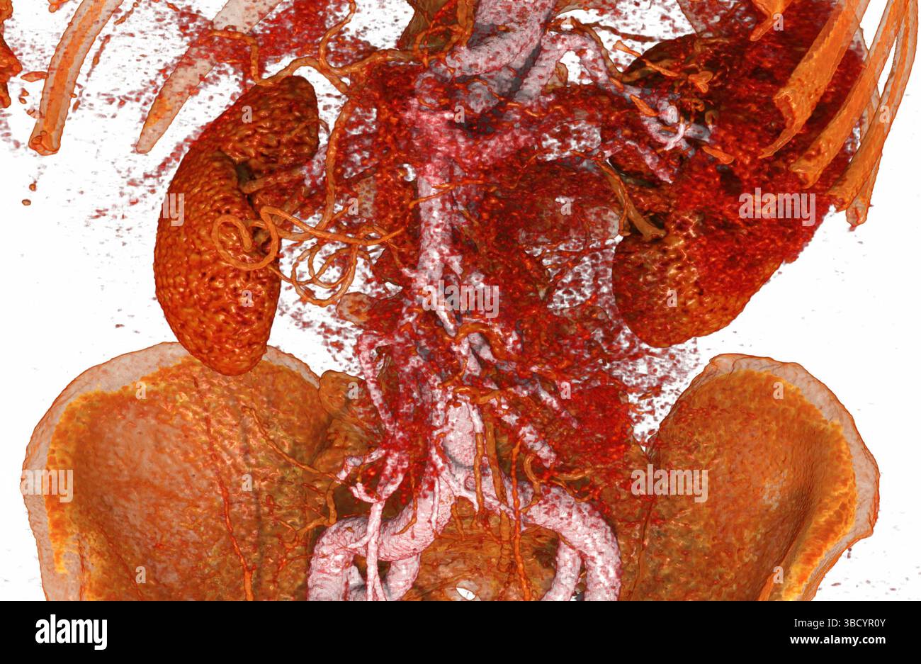 Coloured 3D computed tomography (CT) angiogram scan of a healthy ...