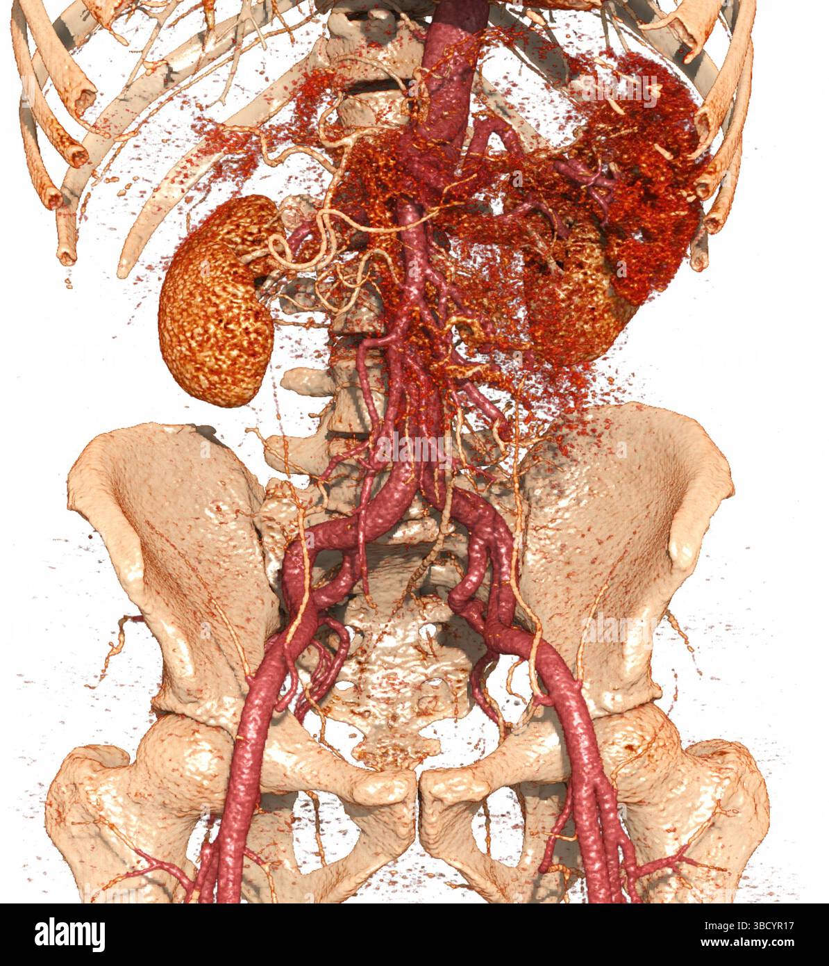 Coloured 3D computed tomography (CT) angiogram scan of a normal abdominal cavity showing the ...