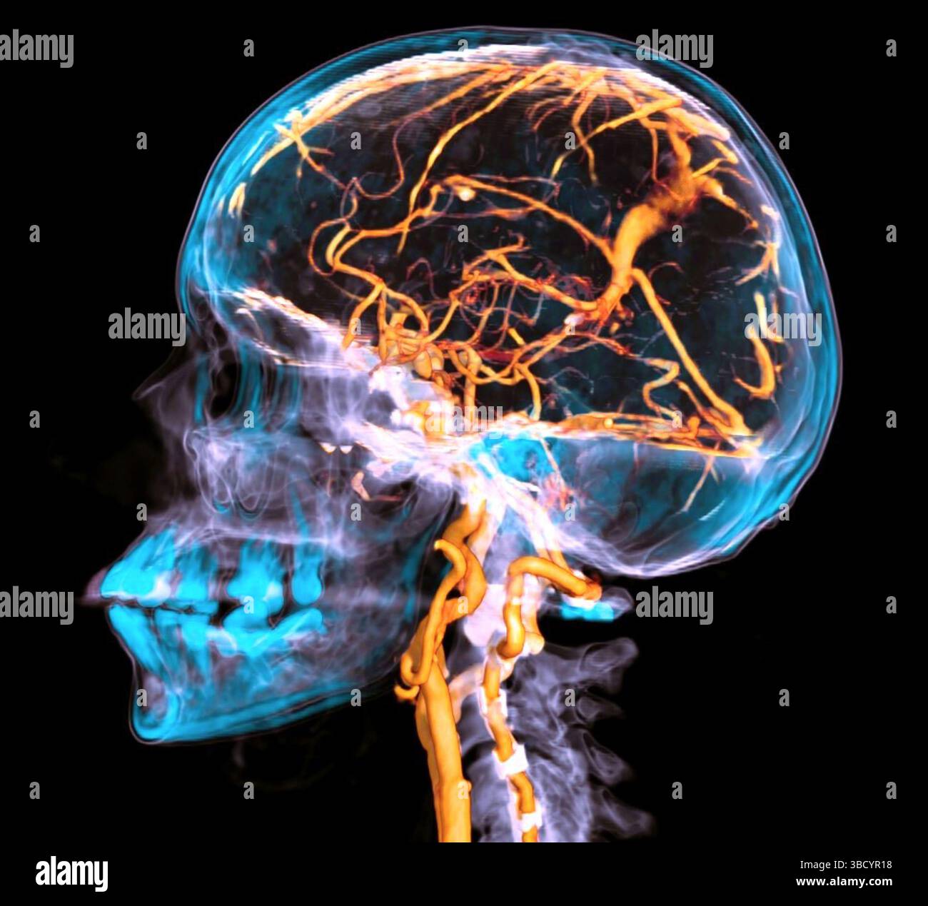 Coloured 3D computed tomography (CT) angiogram scan of healthy brain and neck arteries Stock ...