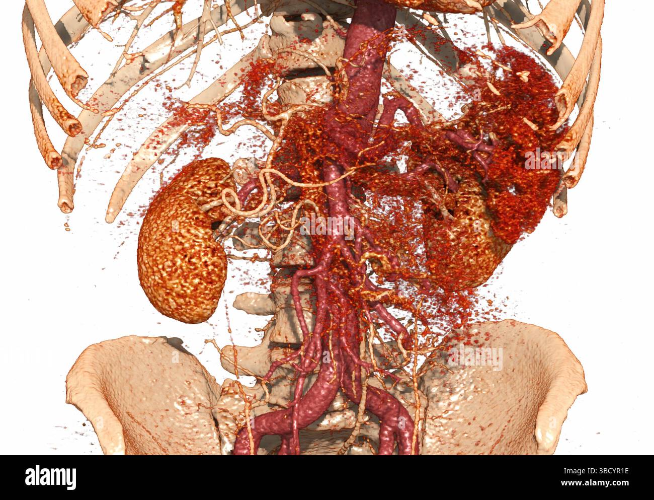 Coloured 3D computed tomography (CT) angiogram scan of a healthy abdominal cavity showing the ...