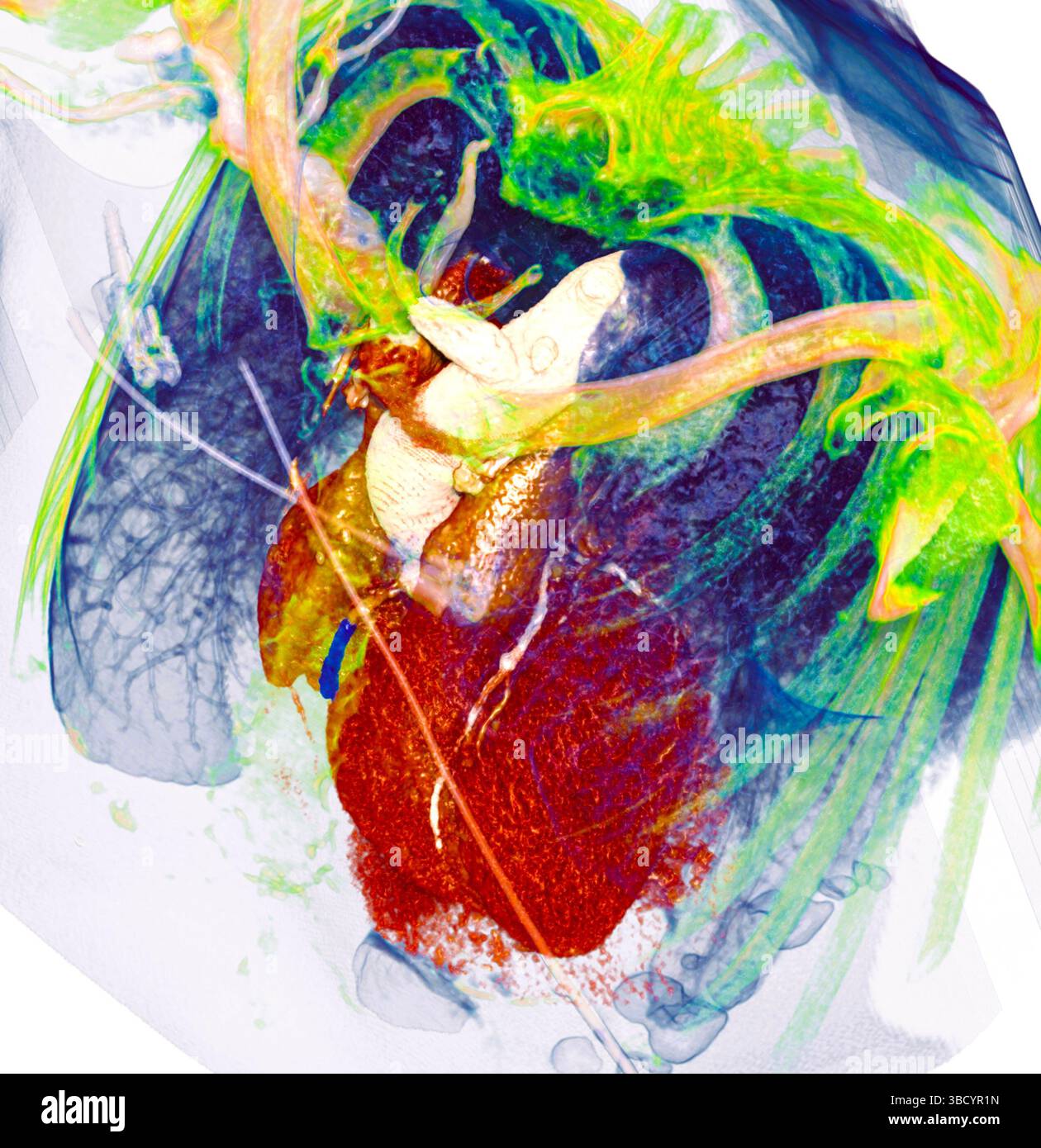 Coloured 3D computed tomography (CT) angiogram scan of a heart with a coronary artery stent ...