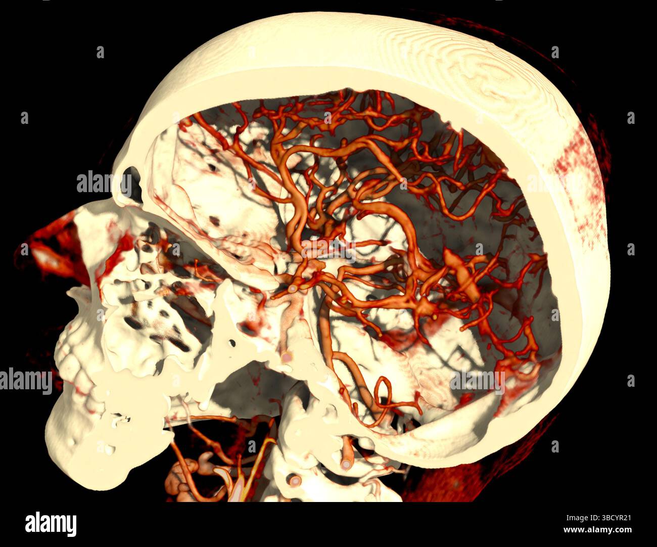 Coloured 3D computed tomography (CT) angiogram scan of normal brain and neck arteries Stock ...