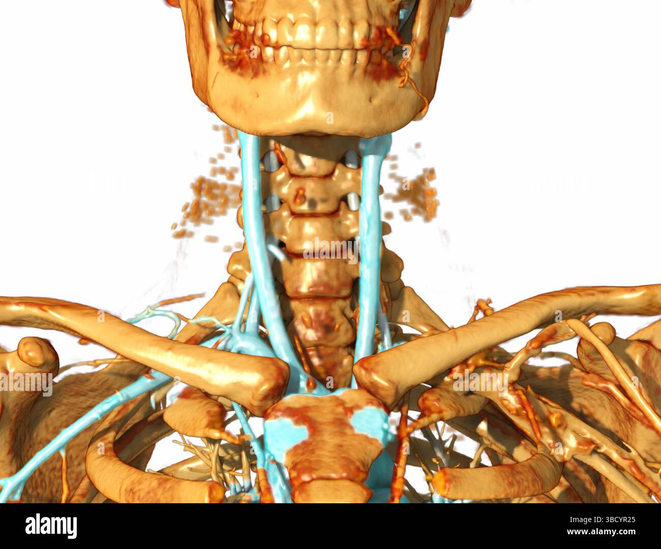 Coloured 3D computed tomography (CT) angiogram scan of healthy brain and neck arteries Stock ...