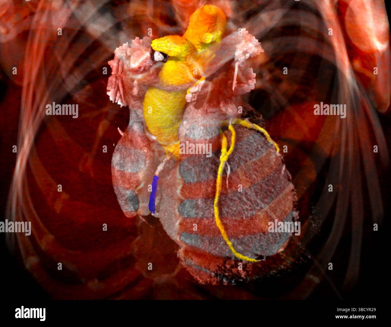 Coloured 3D computed tomography (CT) angiogram scan of a heart with a coronary artery stent to ...