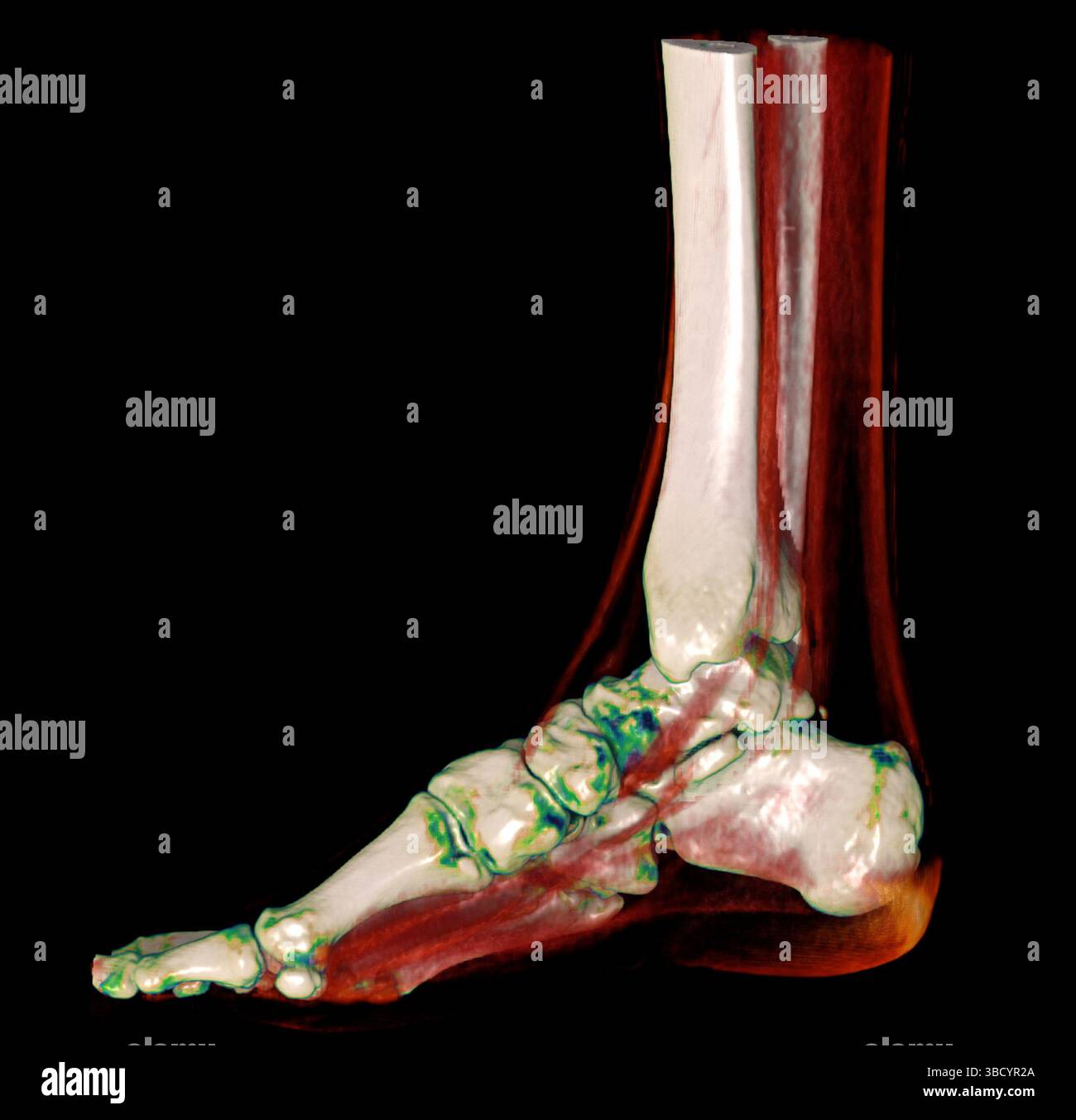 Coloured 3D computed tomography (CT) scan of a healthy foot Stock Photo ...