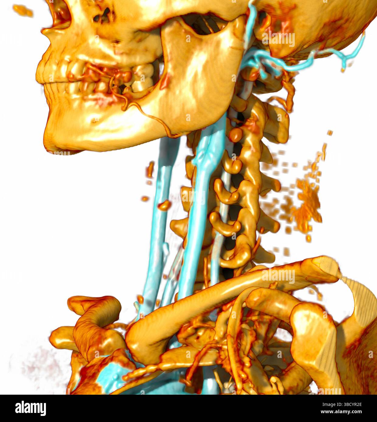 Coloured 3D computed tomography (CT) angiogram scan of healthy brain and neck arteries Stock ...