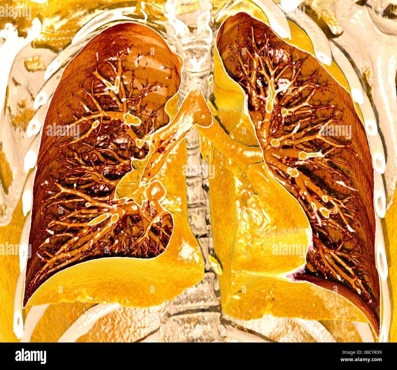 Coloured 3D computed tomography (CT) scan of healthy lungs, showing the main bronchi (pink) and ...