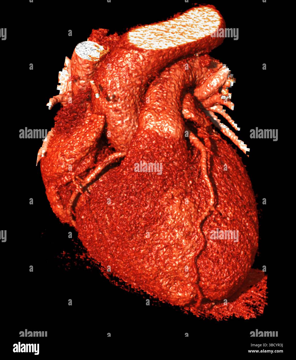 Coloured 3D computed tomography (CT) angiogram scan of a normal heart ...