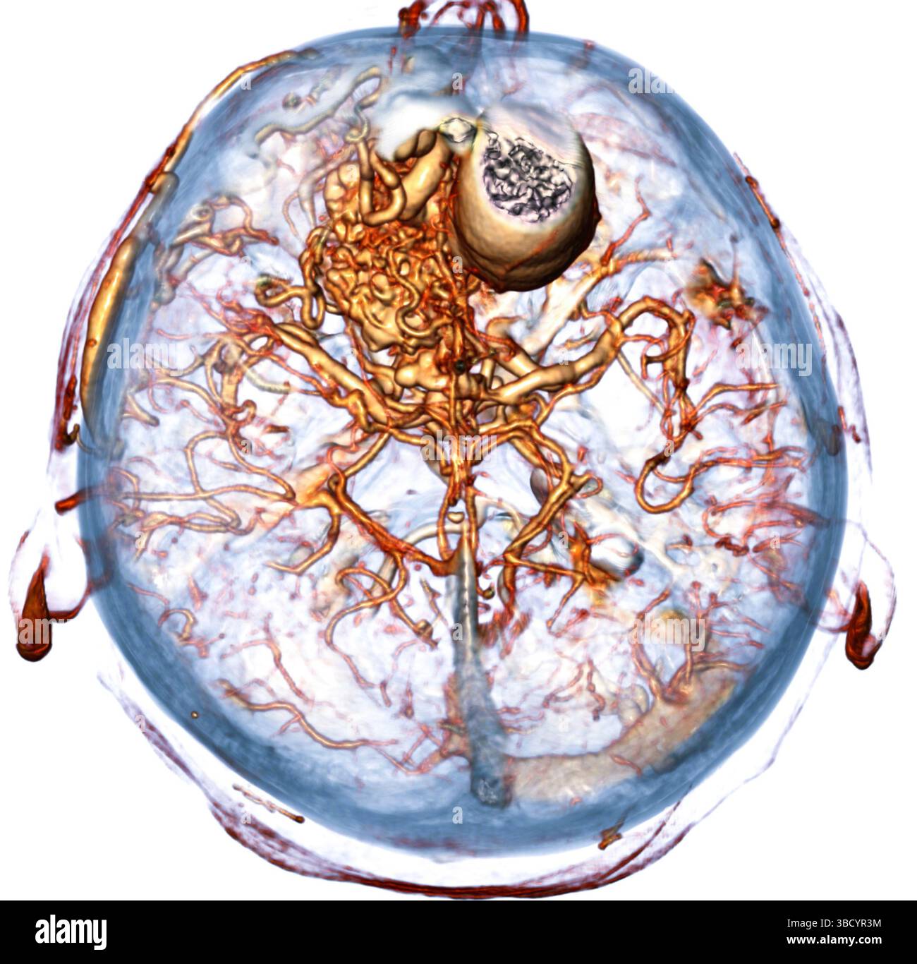 Coloured 3D computed tomography (CT) angiogram scan of a brain with a giant arteriovenous ...
