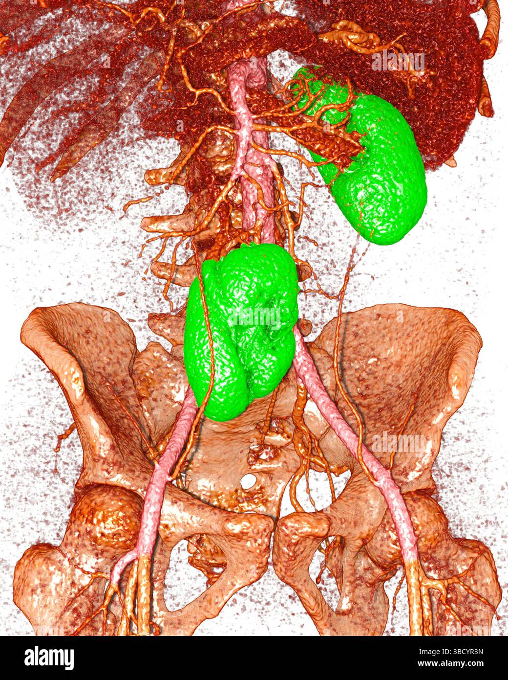 Kidney dystopia, CT angiogram Stock Photo - Alamy