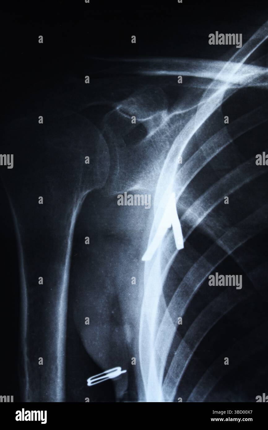 Xray film shoulder ray hi-res stock photography and images - Alamy
