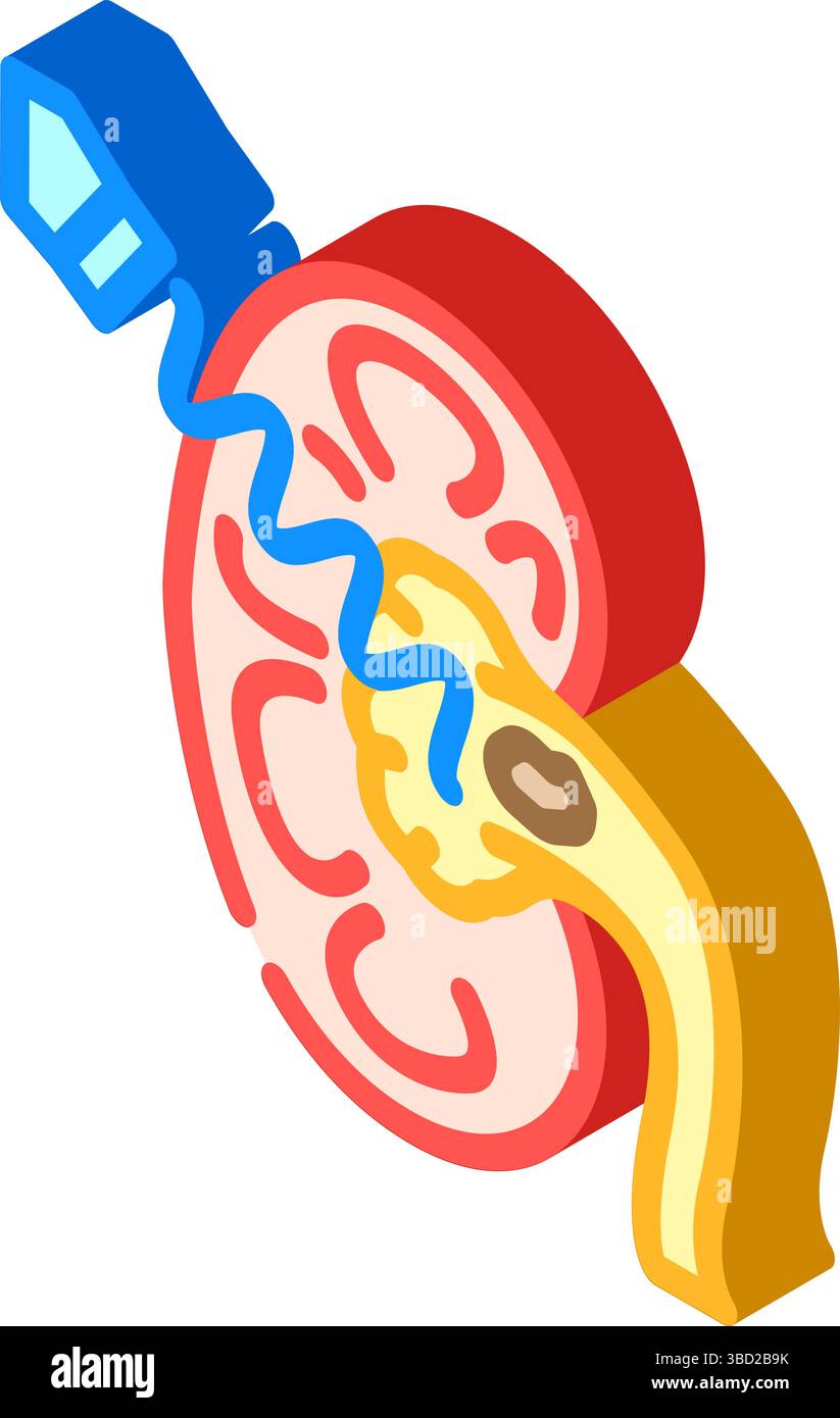 Varicocele hi-res stock photography and images - Alamy