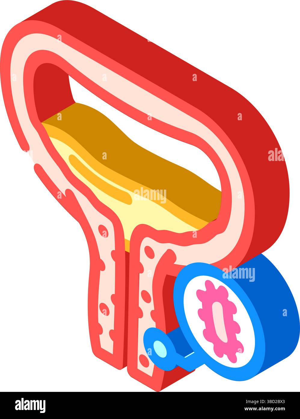 urethritis urology isometric icon vector illustration Stock Vector ...