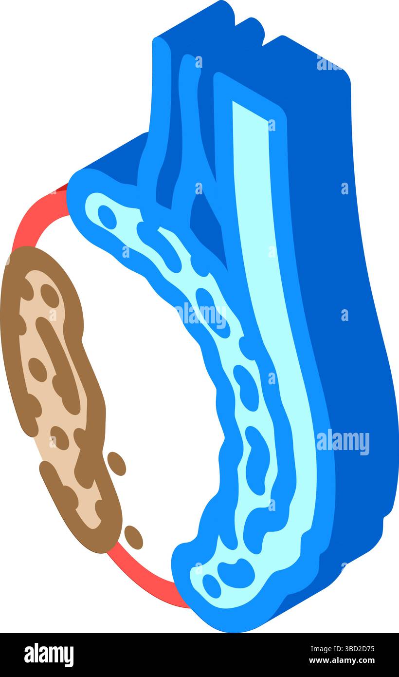 testicular cancer urology isometric icon vector illustration Stock ...