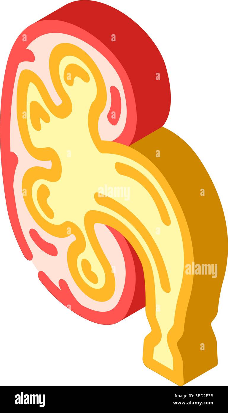 hydronephrosis urology isometric icon vector illustration Stock Vector ...