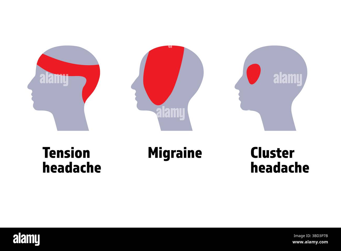 Common types of headache, migraine, tension headache and cluster ...