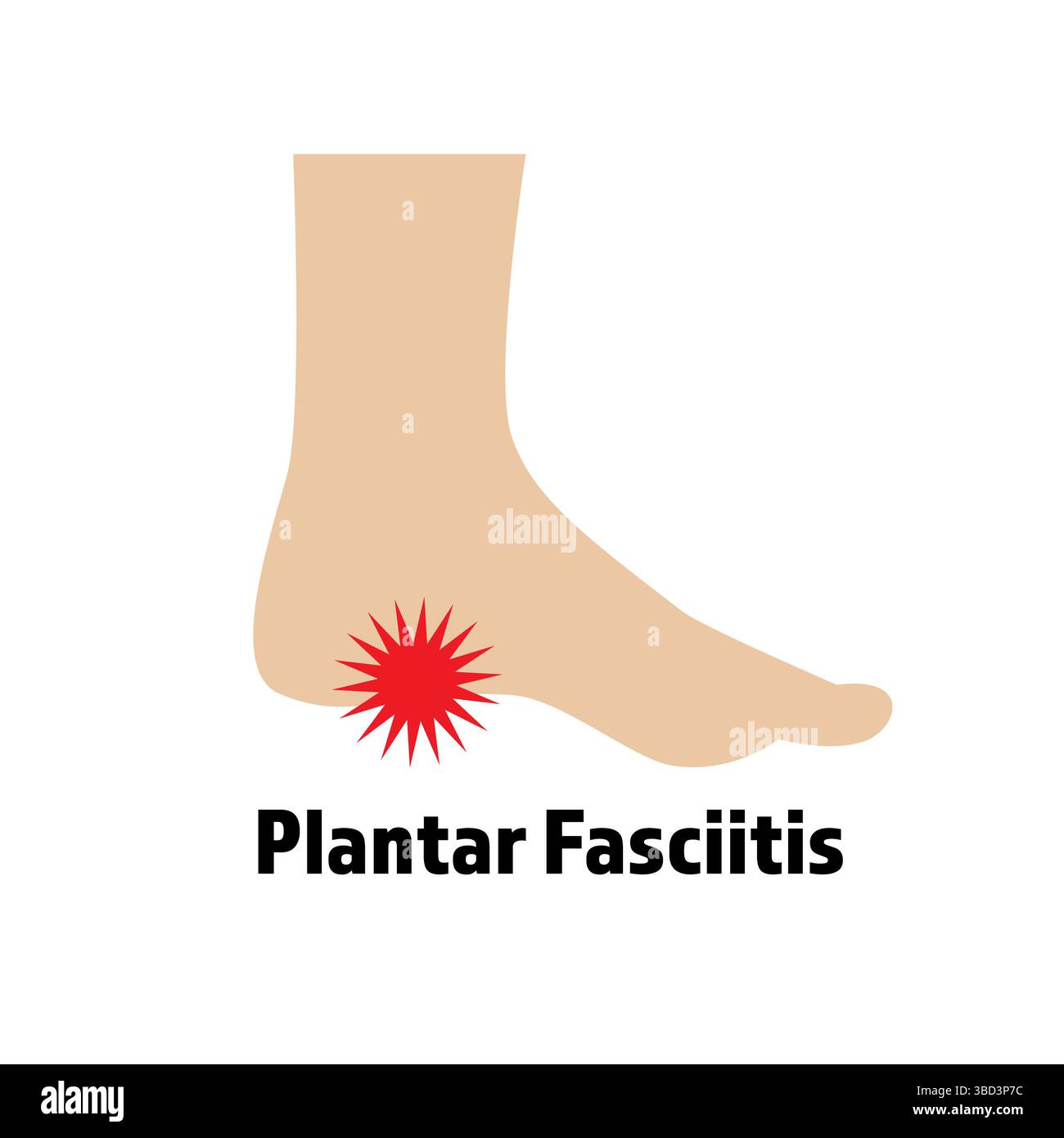Plantar fasciitis hi-res stock photography and images - Alamy