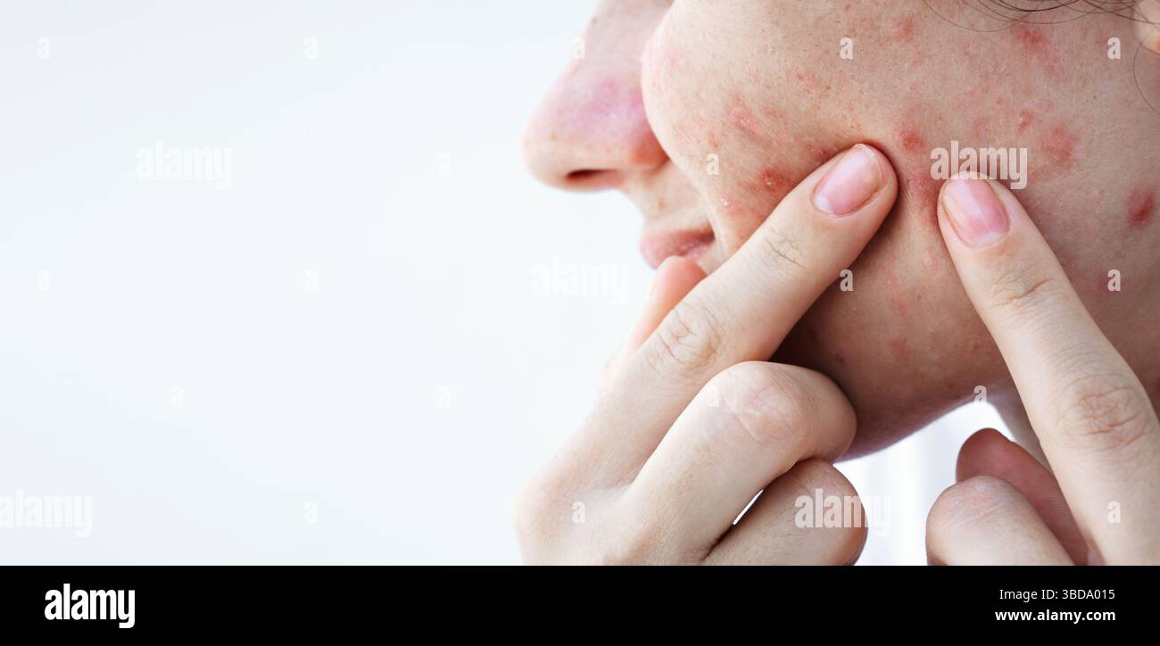 young woman presses acne and pimples on skin on face with fingers ...