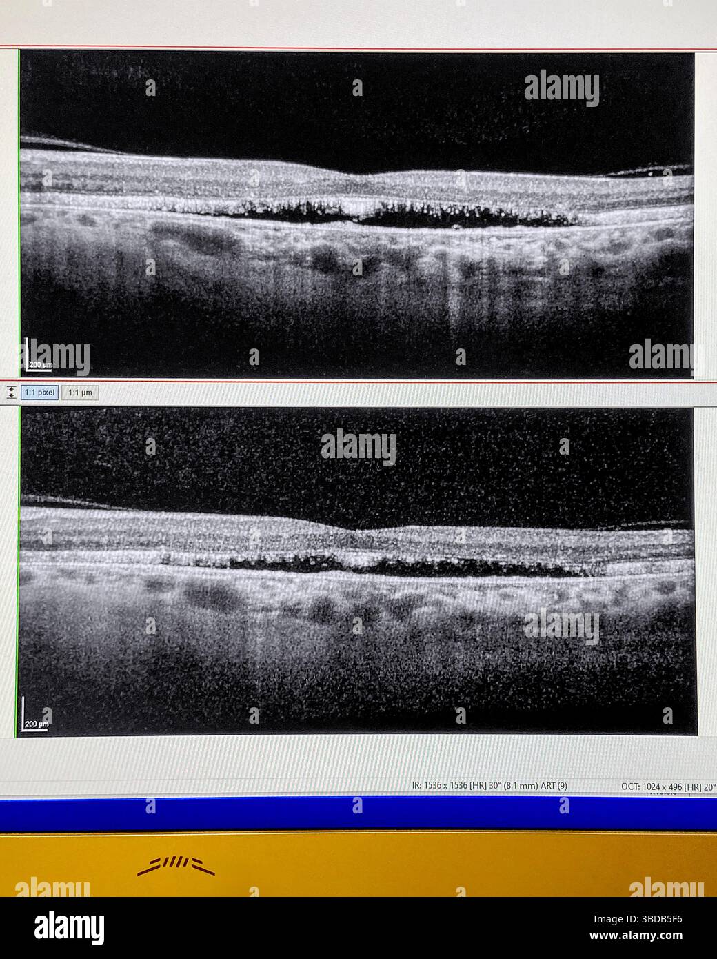 Optical coherence tomography scans hi-res stock photography and images ...