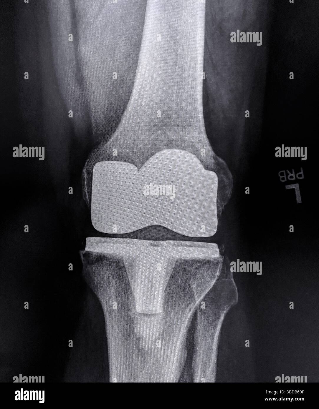 X-ray of adult man's left knee after knee replacement surgery Stock ...