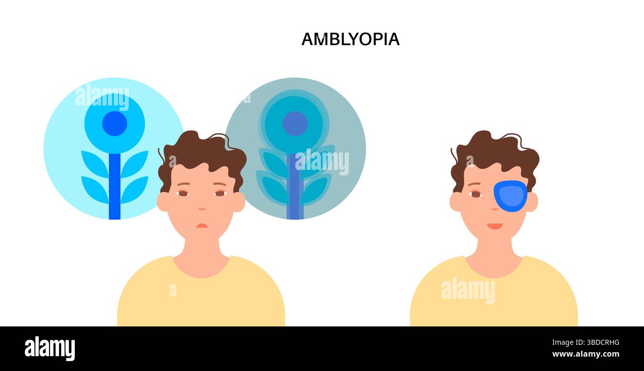 Illustration of amblyopia, also called lazy eye. This is reduced vision ...