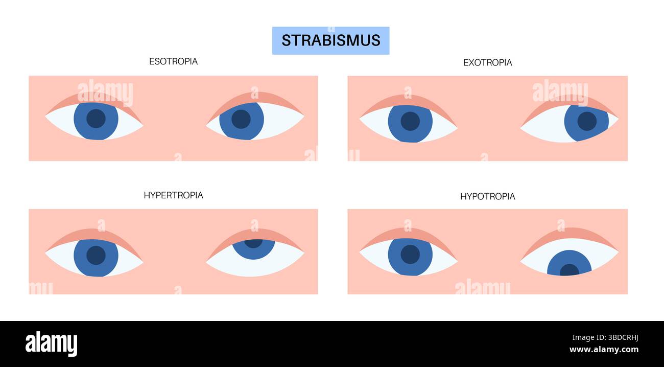 Illustration of strabismus. Also known as eye misalignment, this is a ...