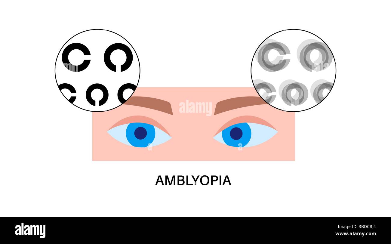 Illustration of amblyopia, also called lazy eye. This is reduced vision ...